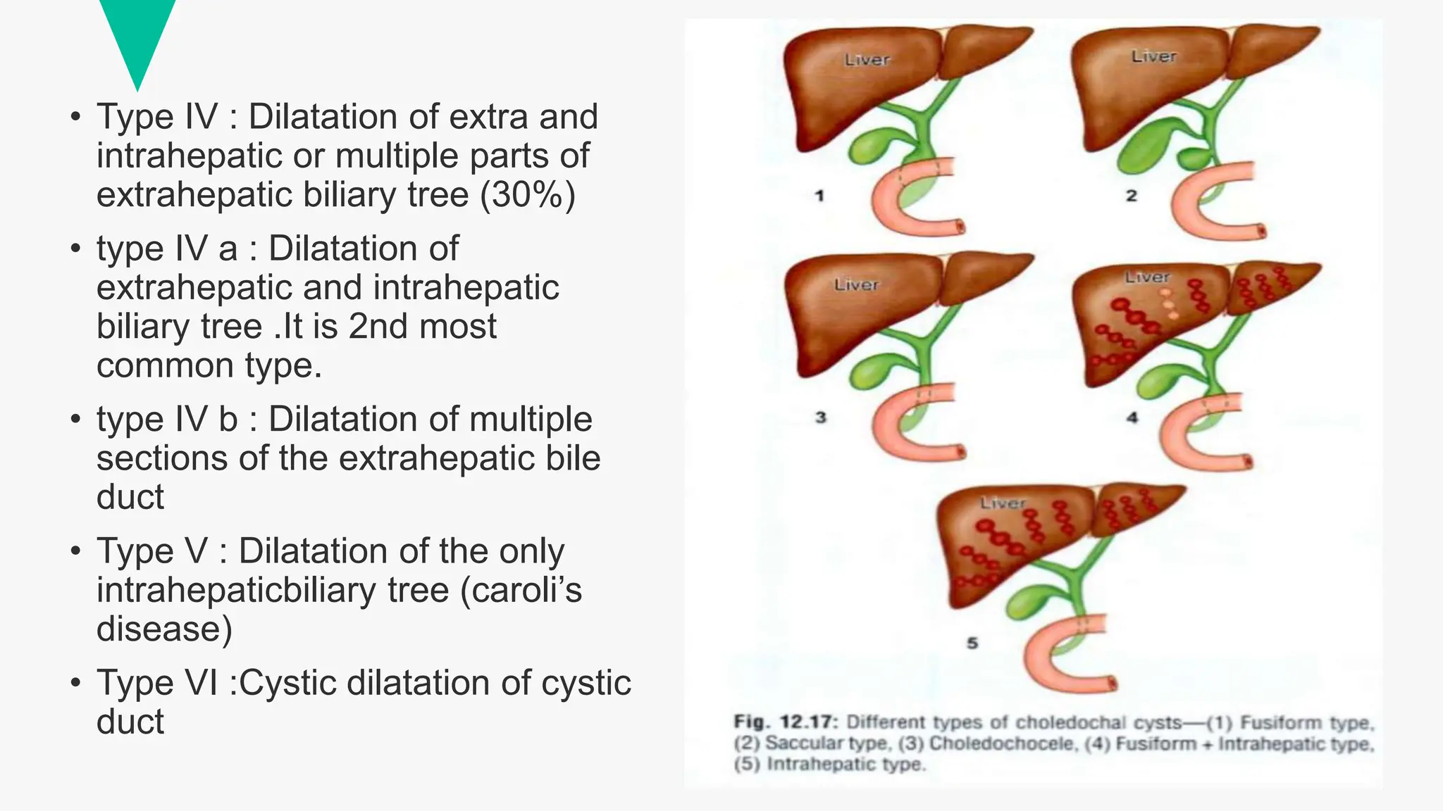 CHOLEDOCHAL CYSTS. Description done pptx | PPTX