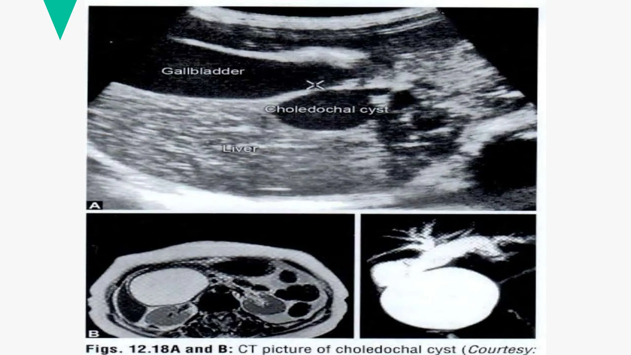 CHOLEDOCHAL CYSTS. Description done pptx | PPT