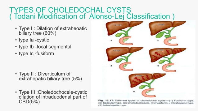 CHOLEDOCHAL CYSTS. Description done pptx | PPT