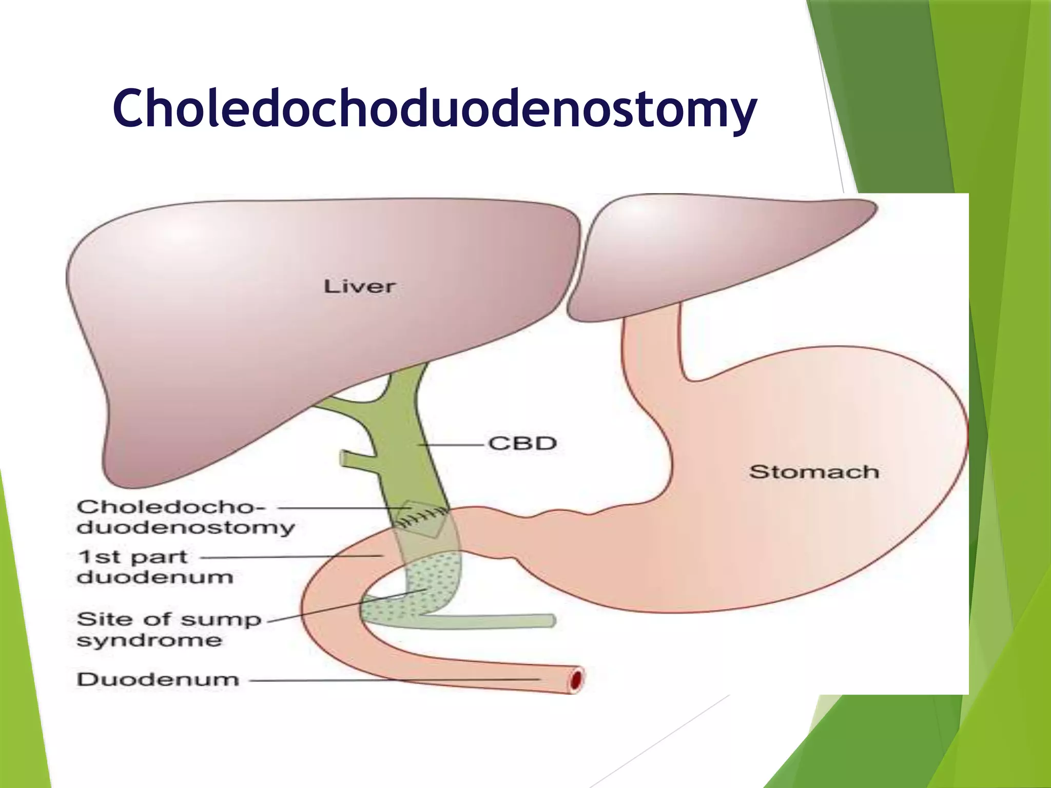 choledocholithiasis-170601193413.pdf