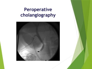 Choledocholithiasis...one step ahead | PPTX