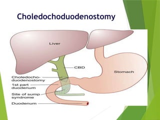 Choledocholithiasis...one step ahead | PPTX