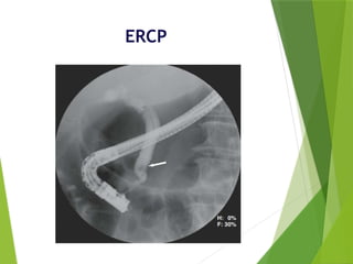 Choledocholithiasis Ercp