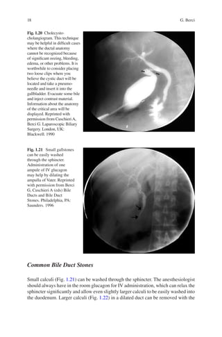 Choledocholithiasis | PDF