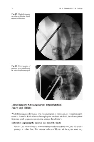Choledocholithiasis | PDF