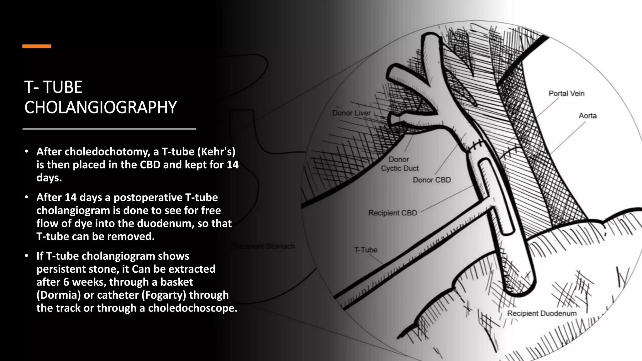 CHOLEDOCHOLITHIASIS.pptx