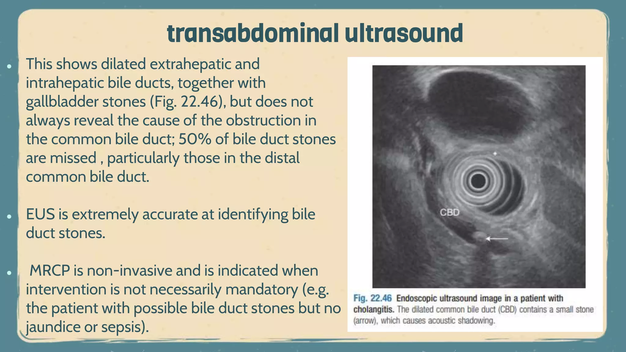Choledocholithiasis.pptx