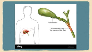 Choledocholithiasis.pptx