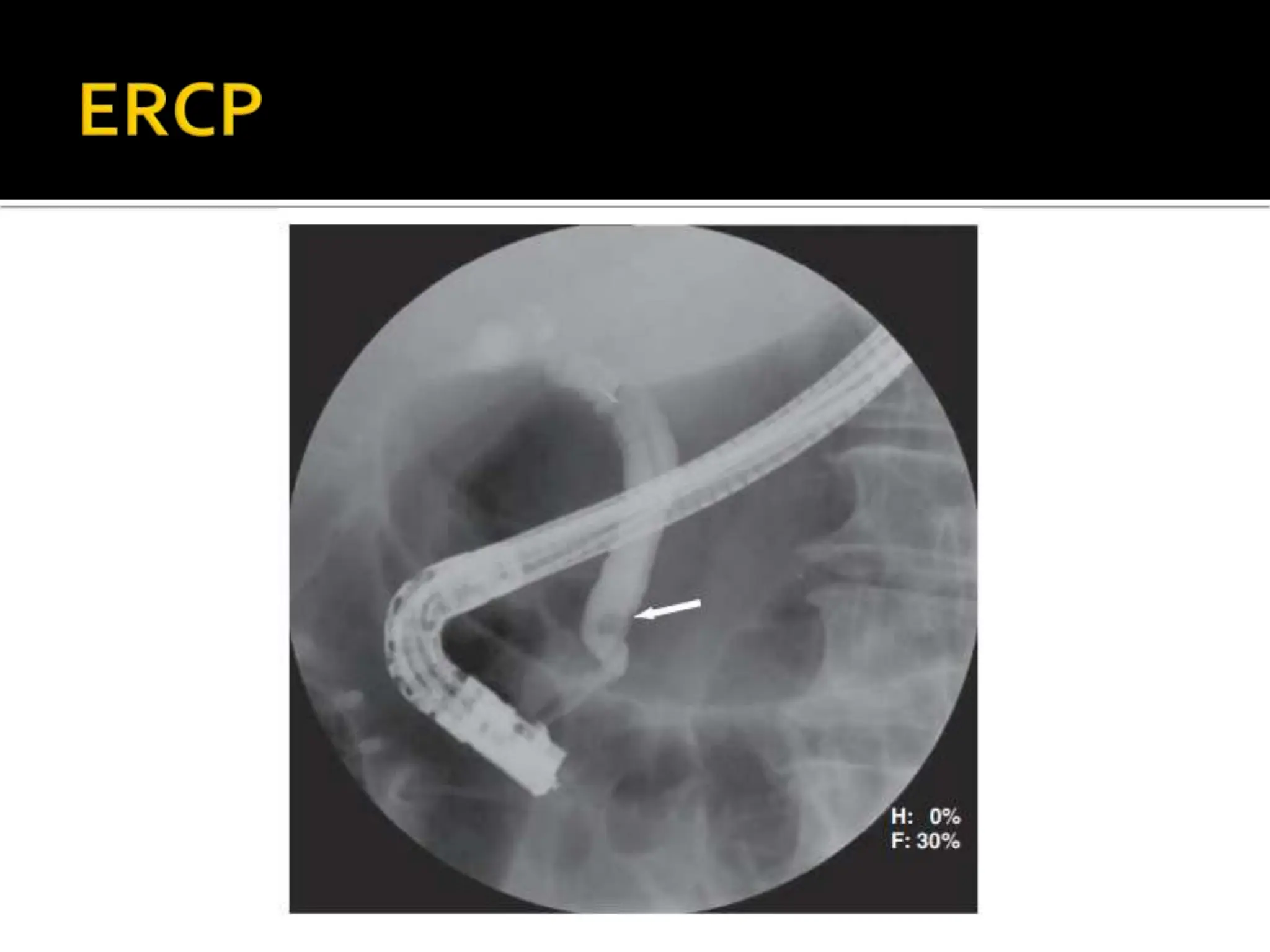 Endocopic, open and laparoscopic management of common bile duct stones.pptx