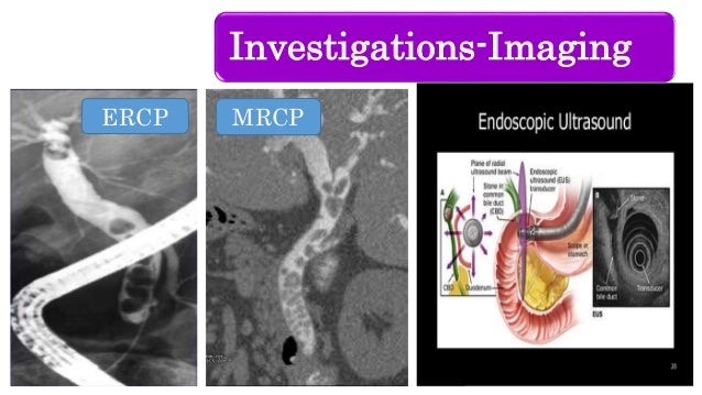 Choledocholithiasis Ercp