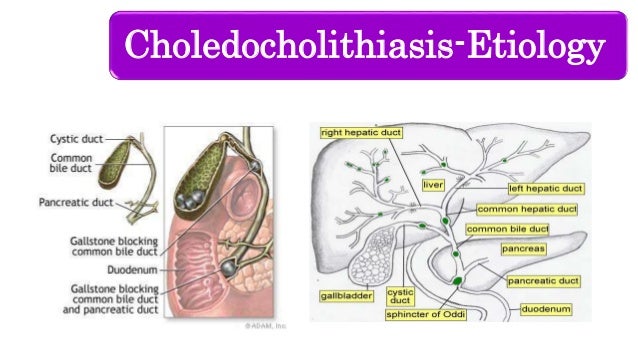 Choledocholithiasis- obstructive jaundice