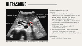 CASE STUDY ON CHOLEDOCHOLITHIASIS CLINICAL PRACTICE.pdf