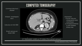 CASE STUDY ON CHOLEDOCHOLITHIASIS CLINICAL PRACTICE.pdf