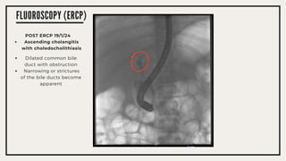 CASE STUDY ON CHOLEDOCHOLITHIASIS CLINICAL PRACTICE.pdf