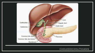 CASE STUDY ON CHOLEDOCHOLITHIASIS CLINICAL PRACTICE.pdf