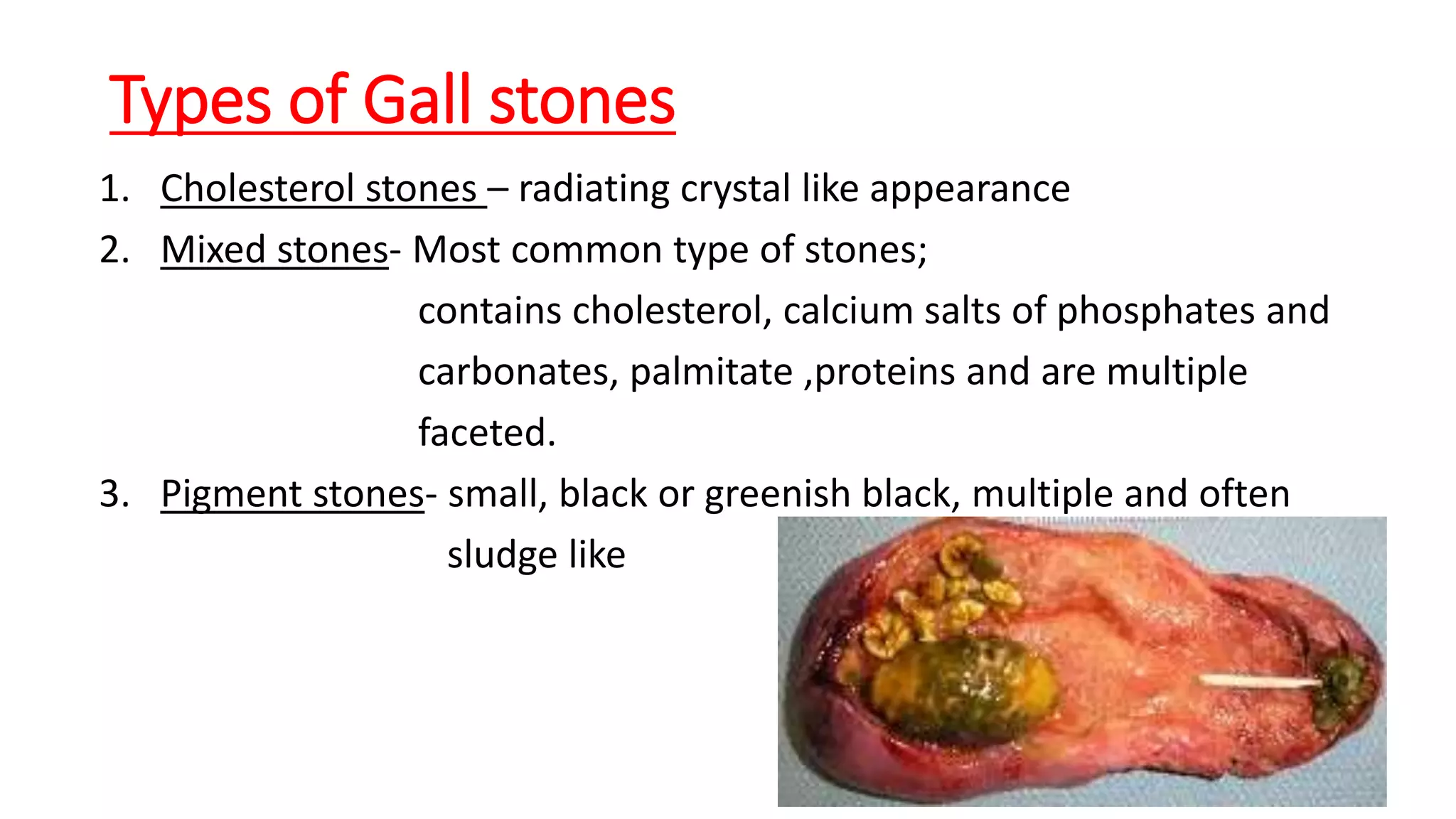 Cholelithiasis | PPTX