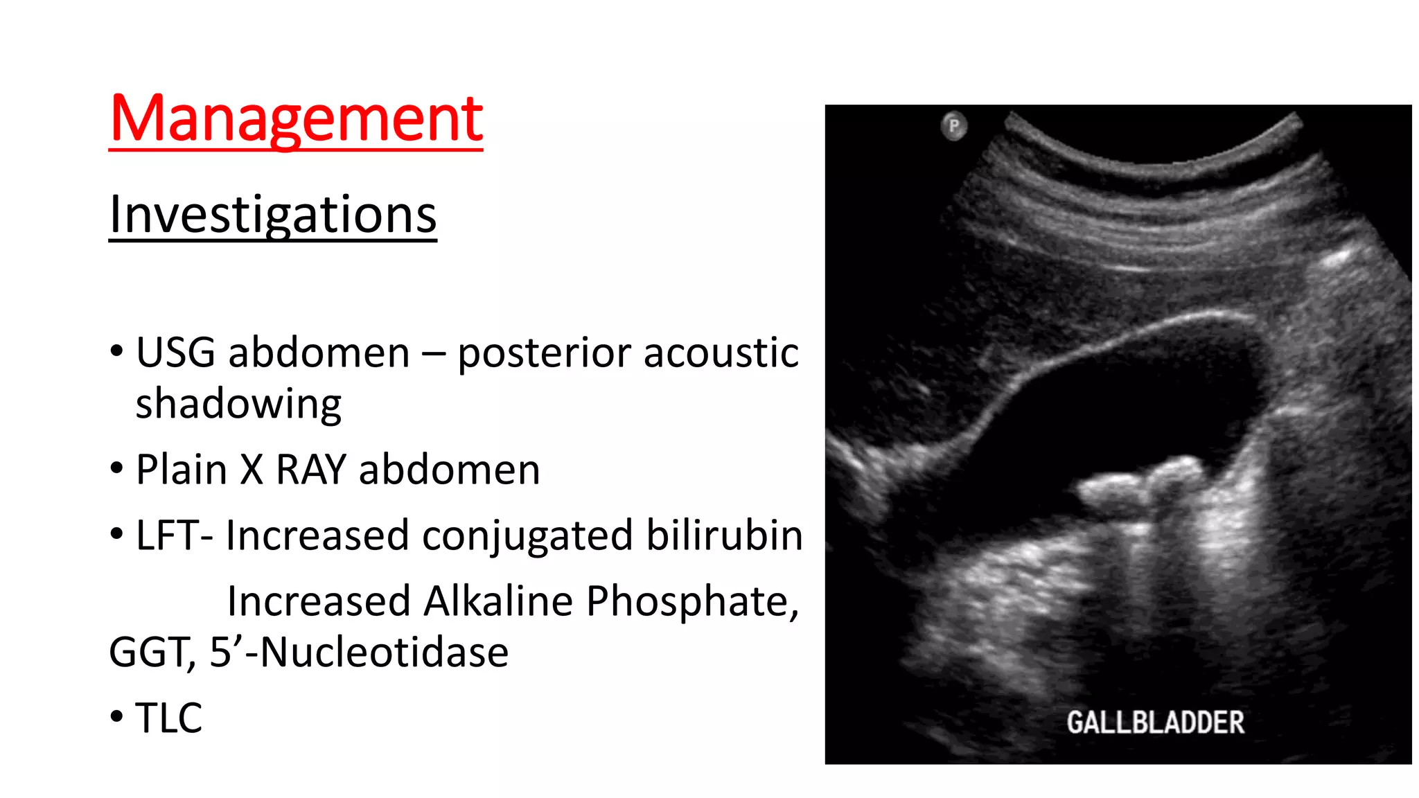 Cholelithiasis | PPTX