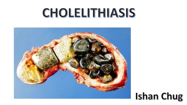 Cholelithiasis | PPTX | Digestive Disorders | Diseases and Conditions