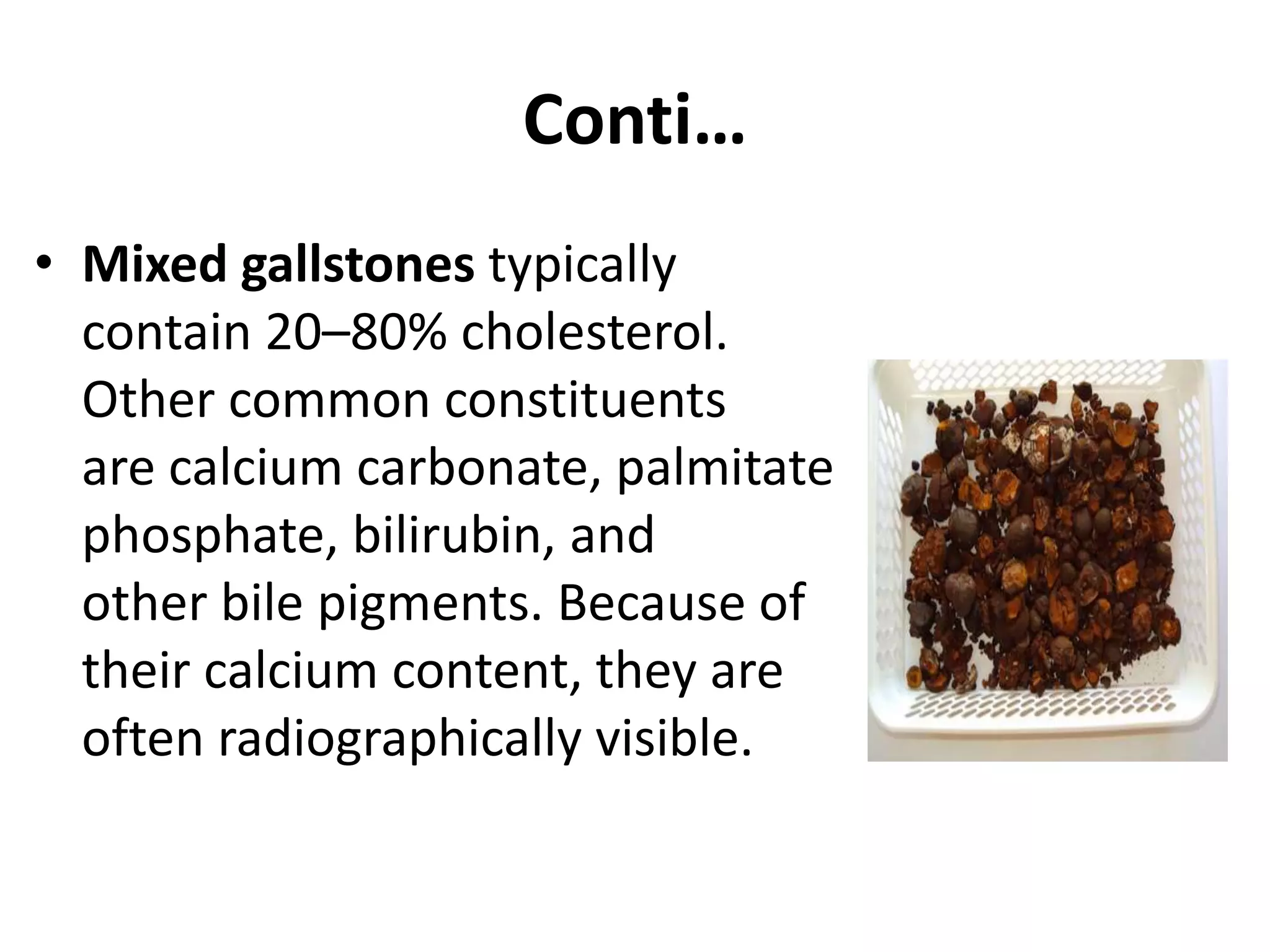 Cholelithiasis disease of GIT | PPTX