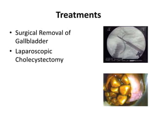 Cholelithiasis disease of GIT | PPTX