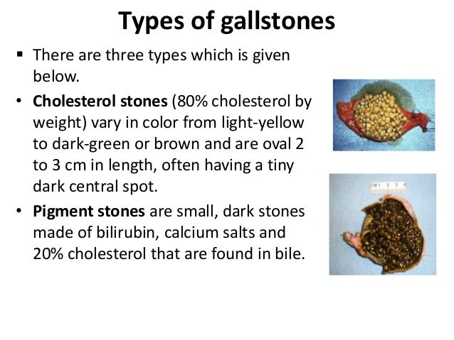 Different Types Of Gall Stones