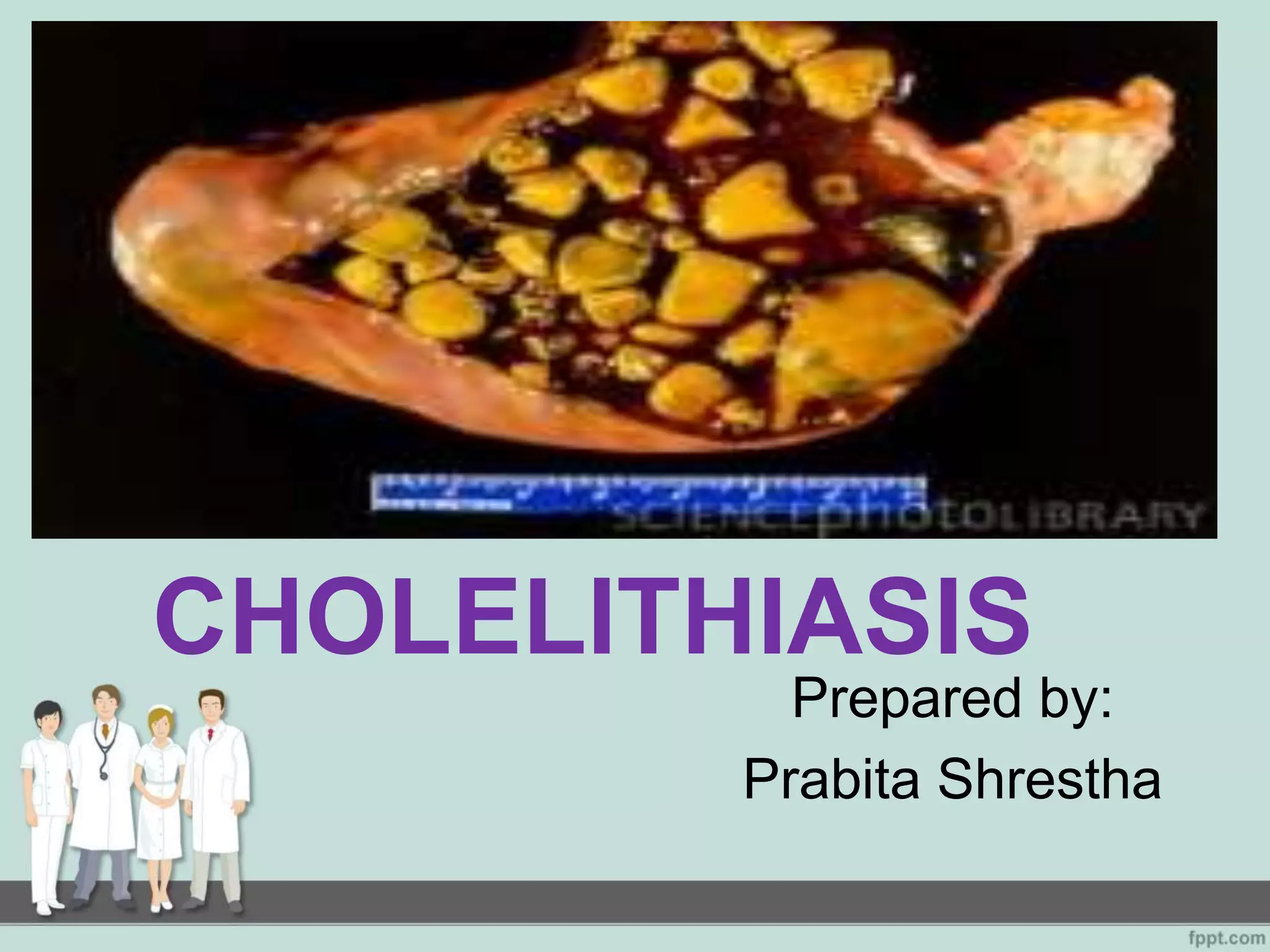 Cholelithiasis | PPTX