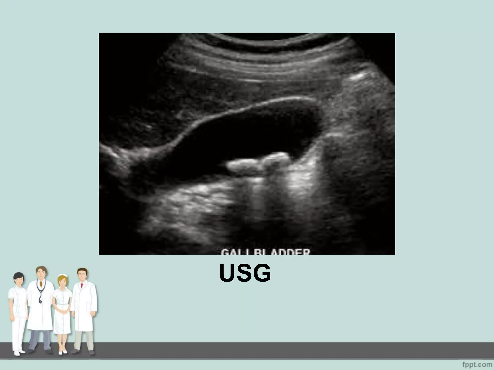 Cholelithiasis | PPTX