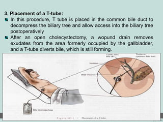 Cholelithiasis | PPTX