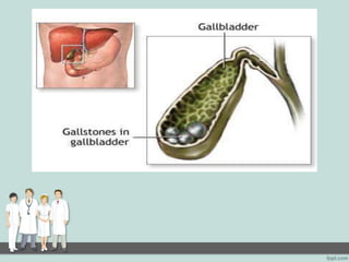 Cholelithiasis | PPTX