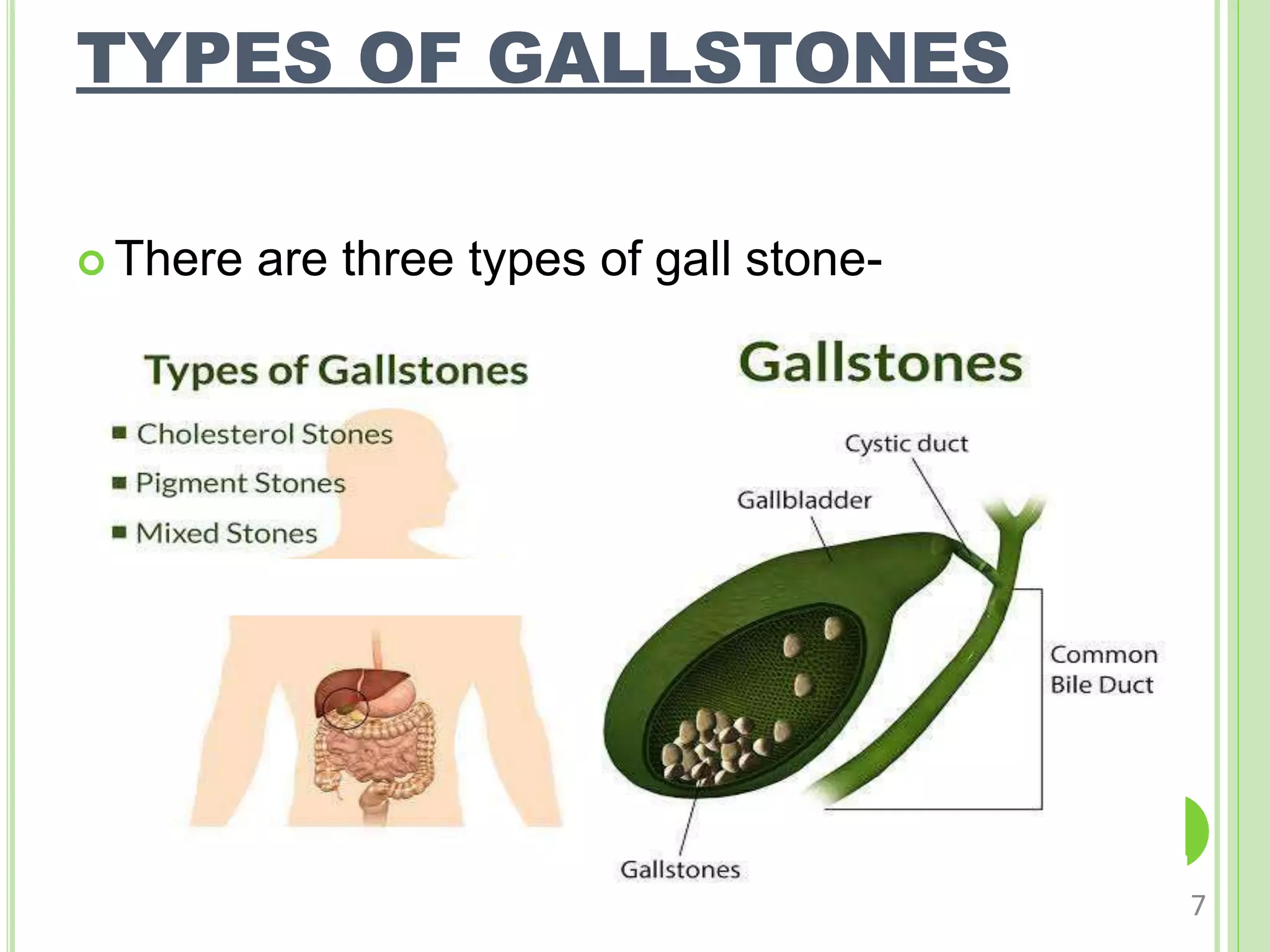 Cholelithiasis GB stone | PPTX