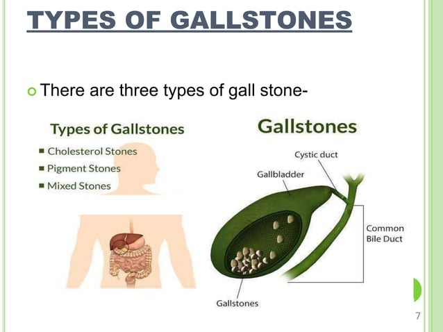 Cholelithiasis GB stone | PPTX | Digestive Disorders | Diseases and ...