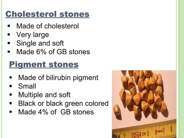 Cholelithiasis GB stone | PPTX | Digestive Disorders | Diseases and ...