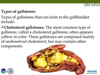 Cholelithiasis | PPT