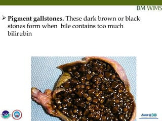 Cholelithiasis | PPT