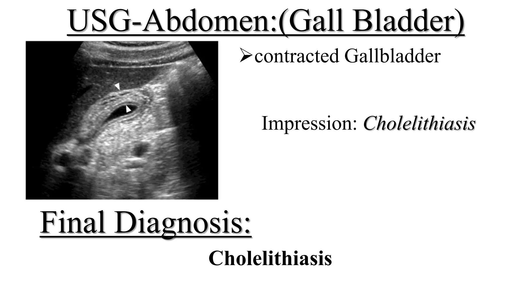 Cholelithiasis | PPT