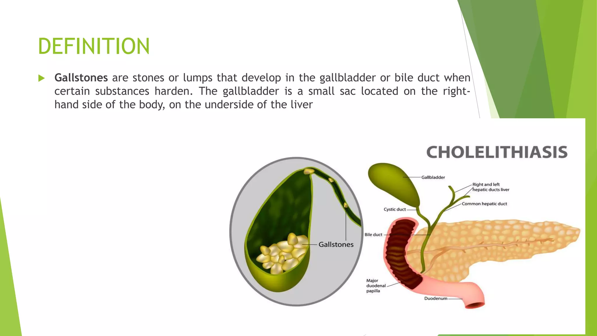 Cholelithiasis | PPTX