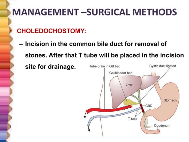 CHOLELITHIASIS | PPTX