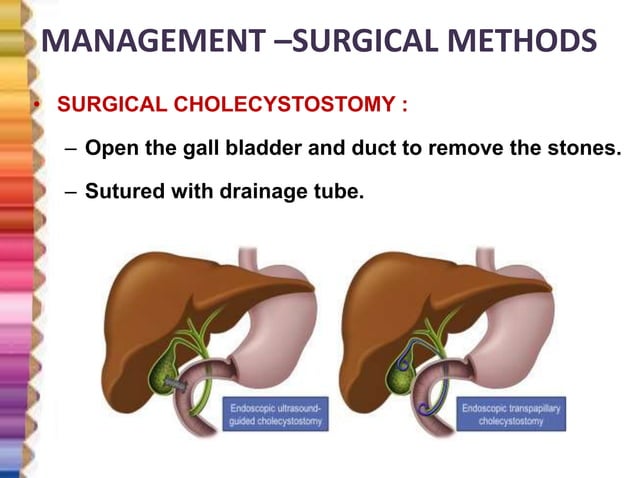CHOLELITHIASIS | PPTX