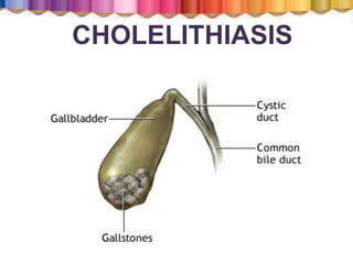 CHOLELITHIASIS | PPT