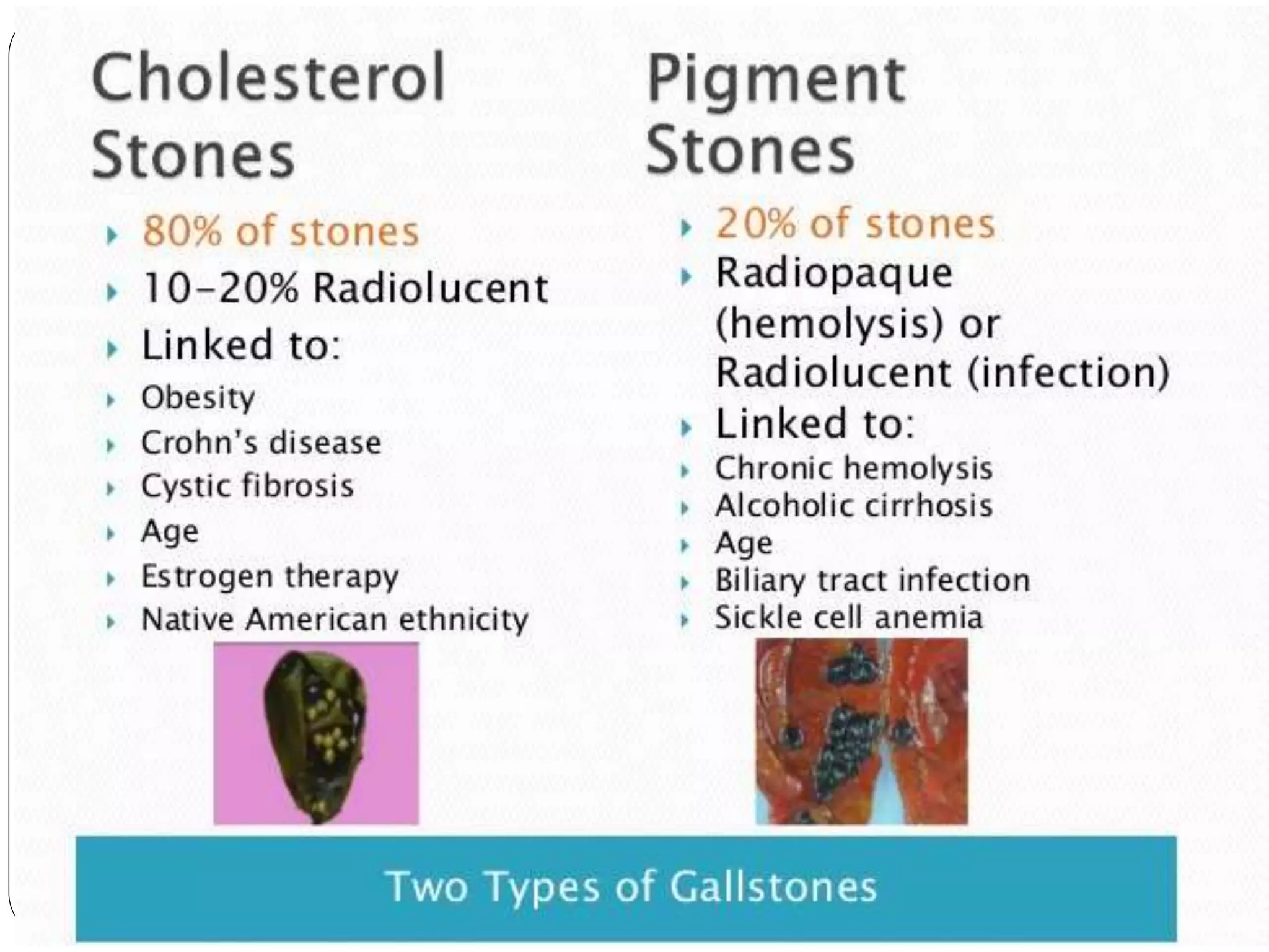 Cholelithiasis (Gall stone) | PPT