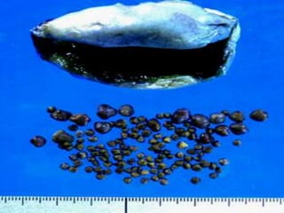 Cholelithiasis (Gall stone) | PPT