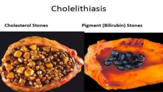 Cholelithiasis | PPTX