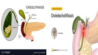 cholelithiasis | PPTX