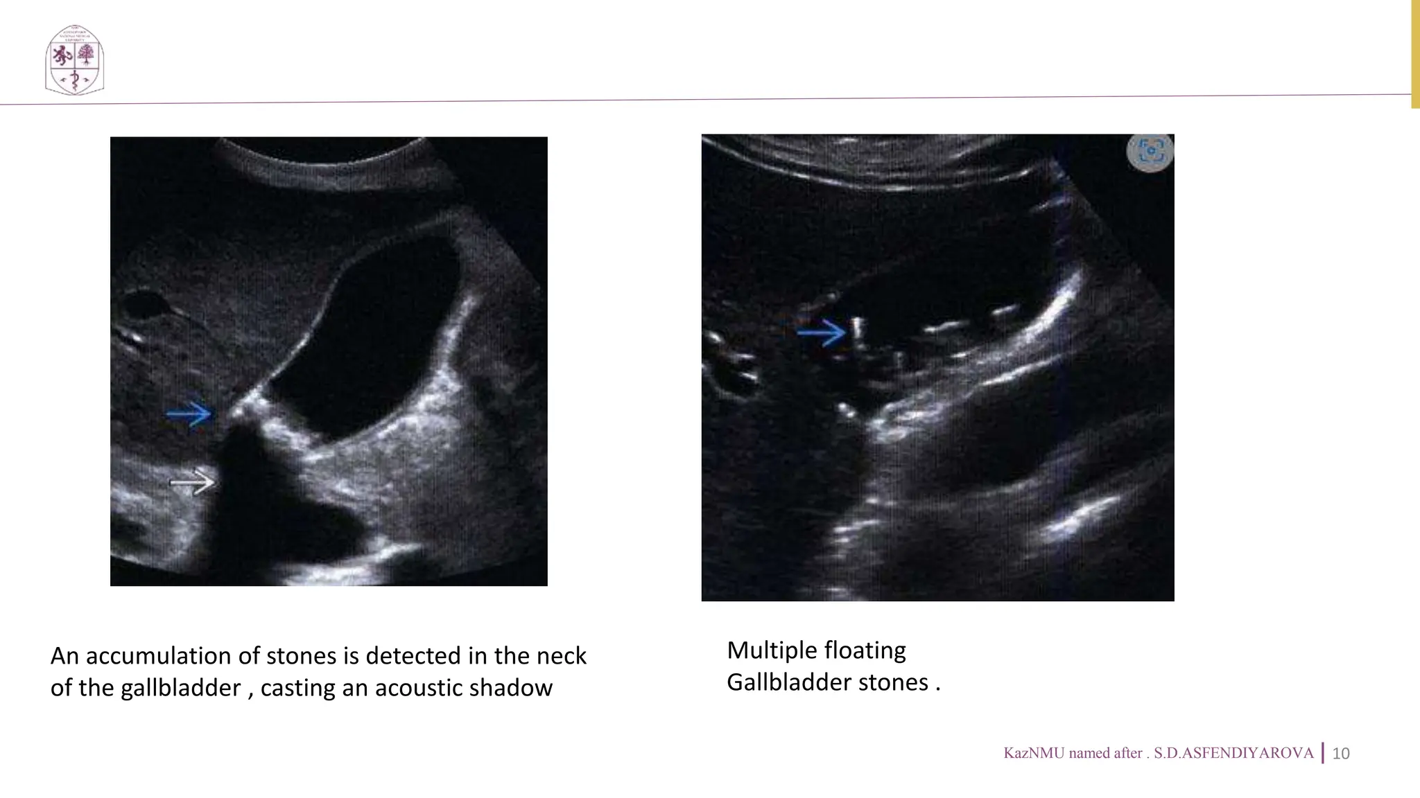 Cholelithiasis full description radiology | PPTX