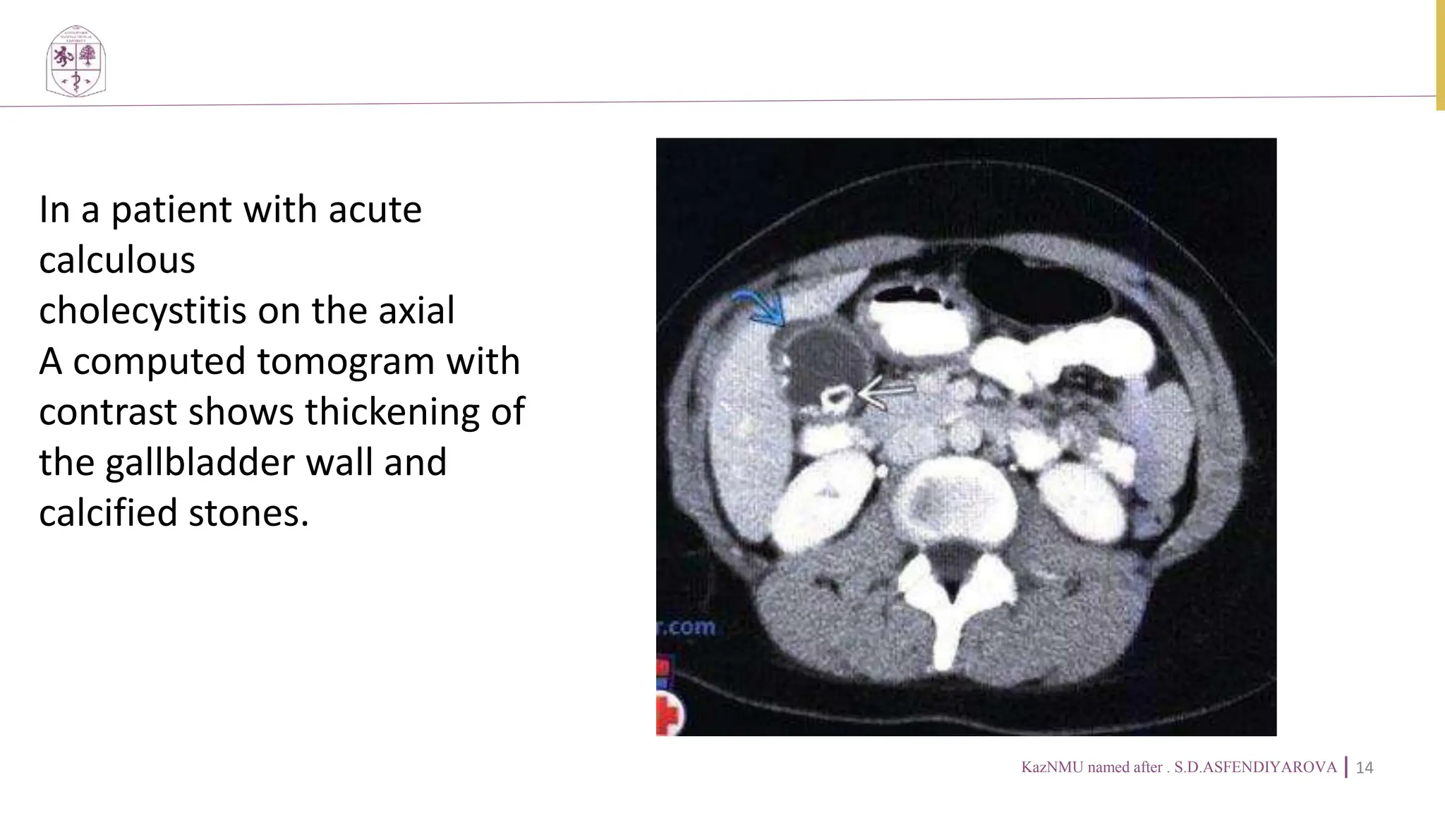 Cholelithiasis full description radiology | PPTX
