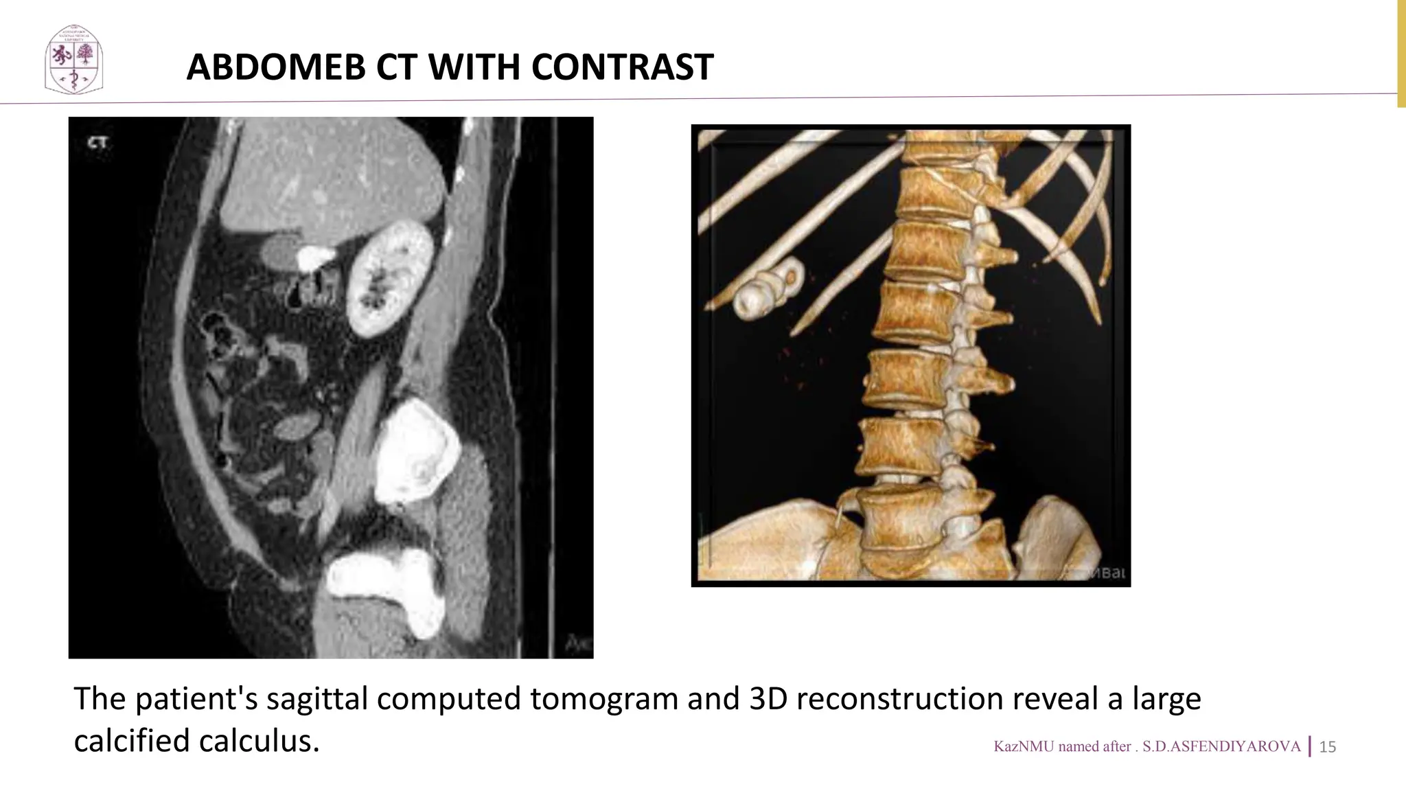 Cholelithiasis full description radiology | PPTX