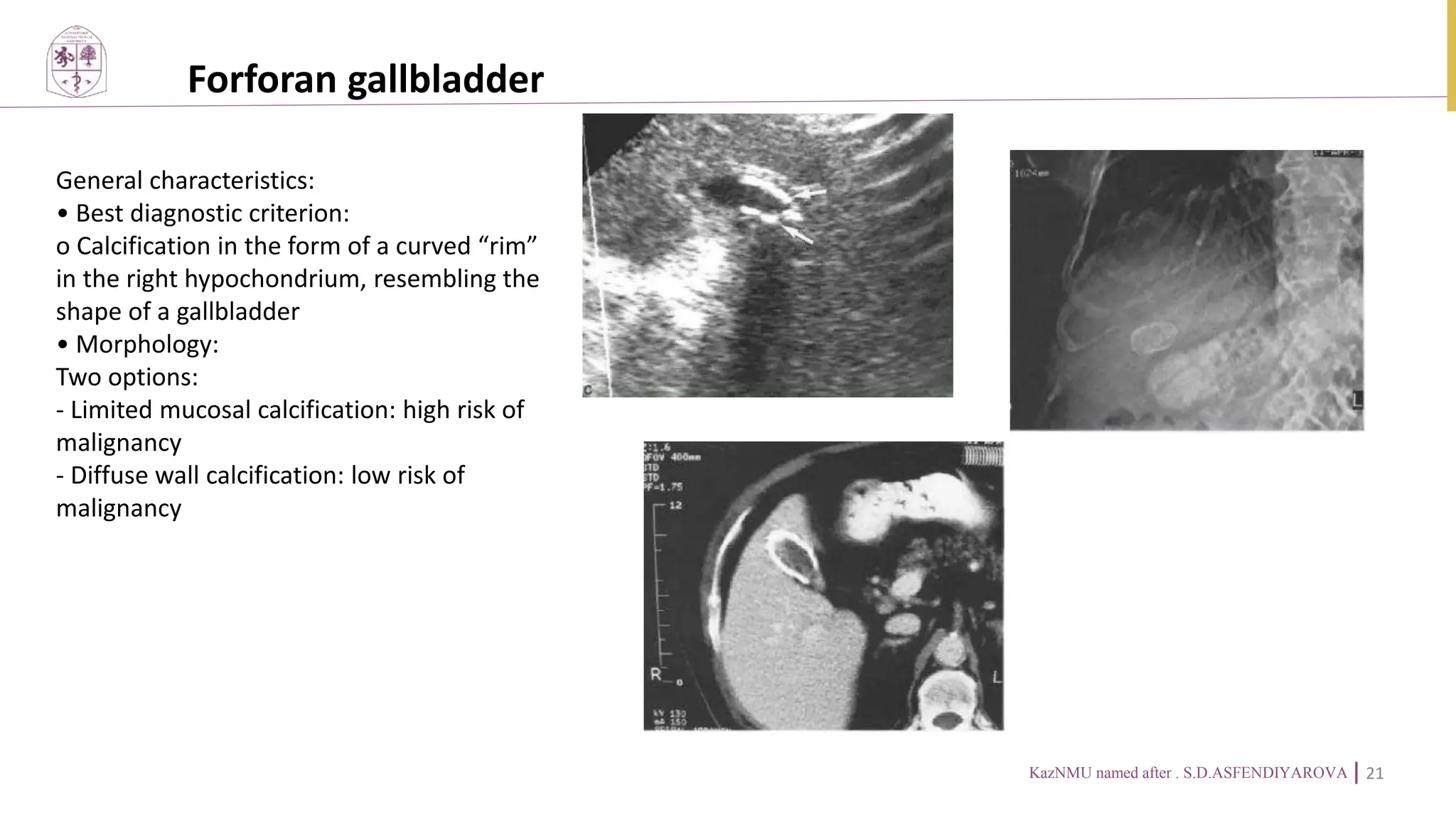 Cholelithiasis full description radiology | PPTX