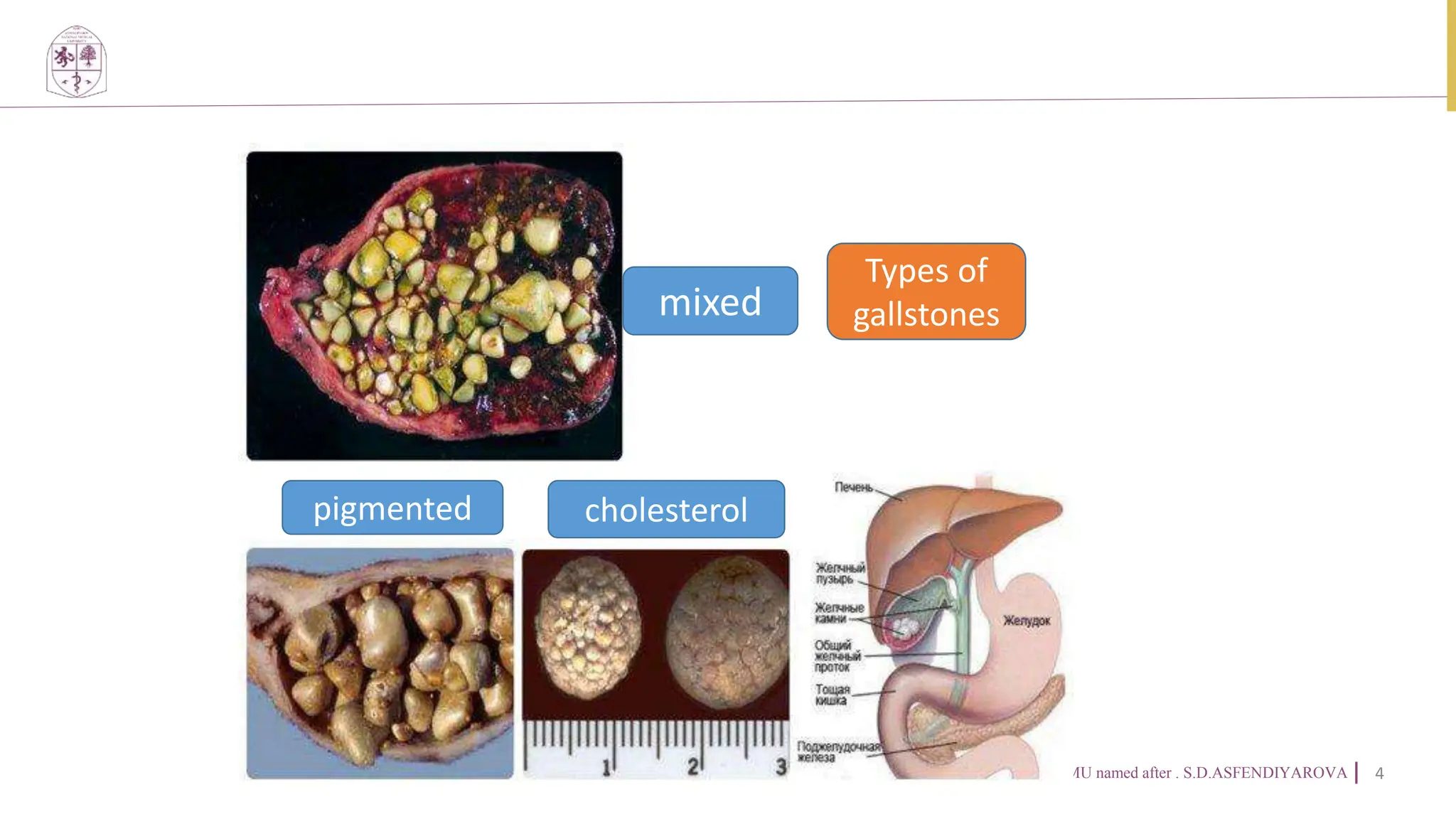 Cholelithiasis full description radiology | PPTX