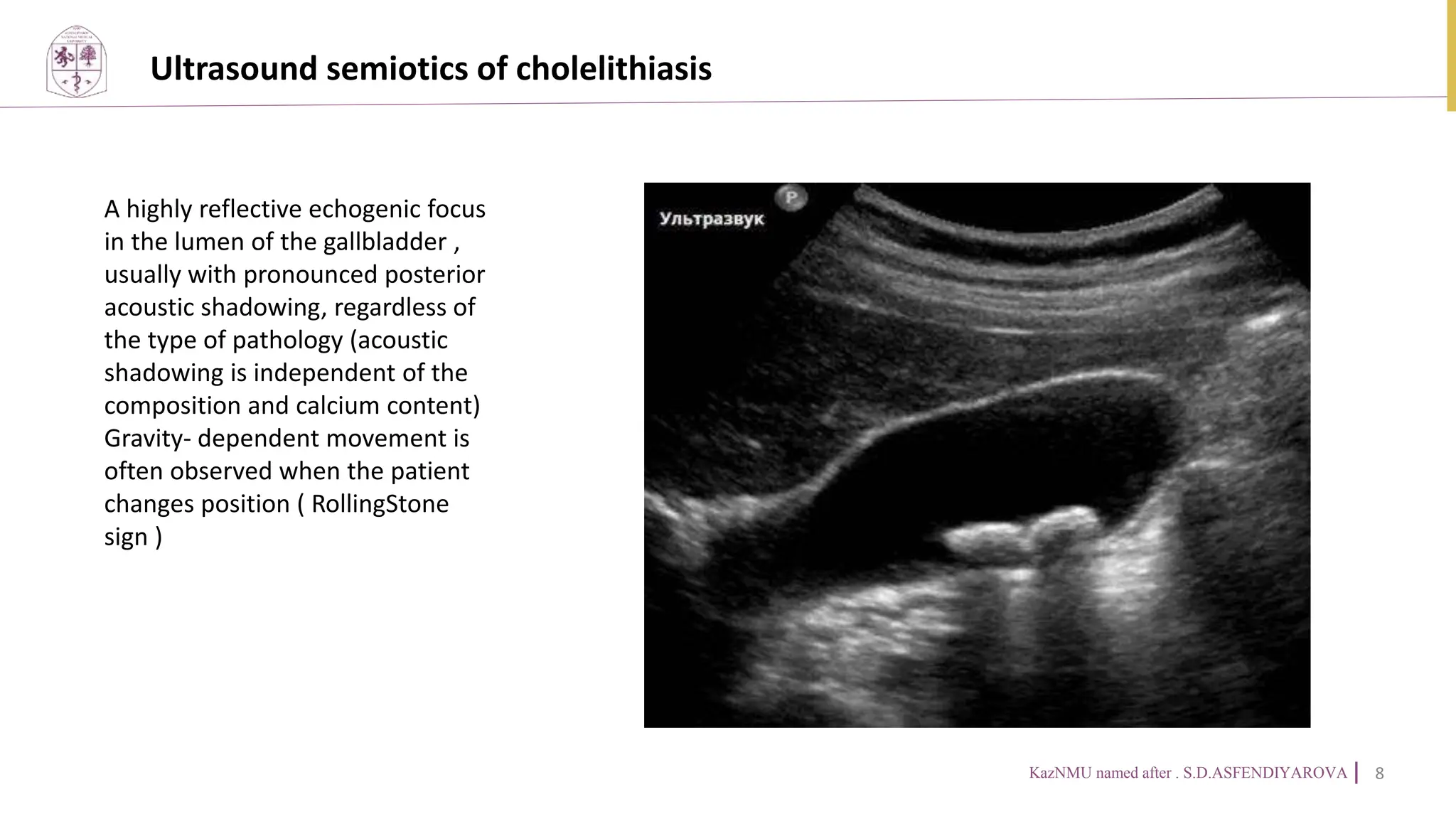 Cholelithiasis full description radiology | PPTX
