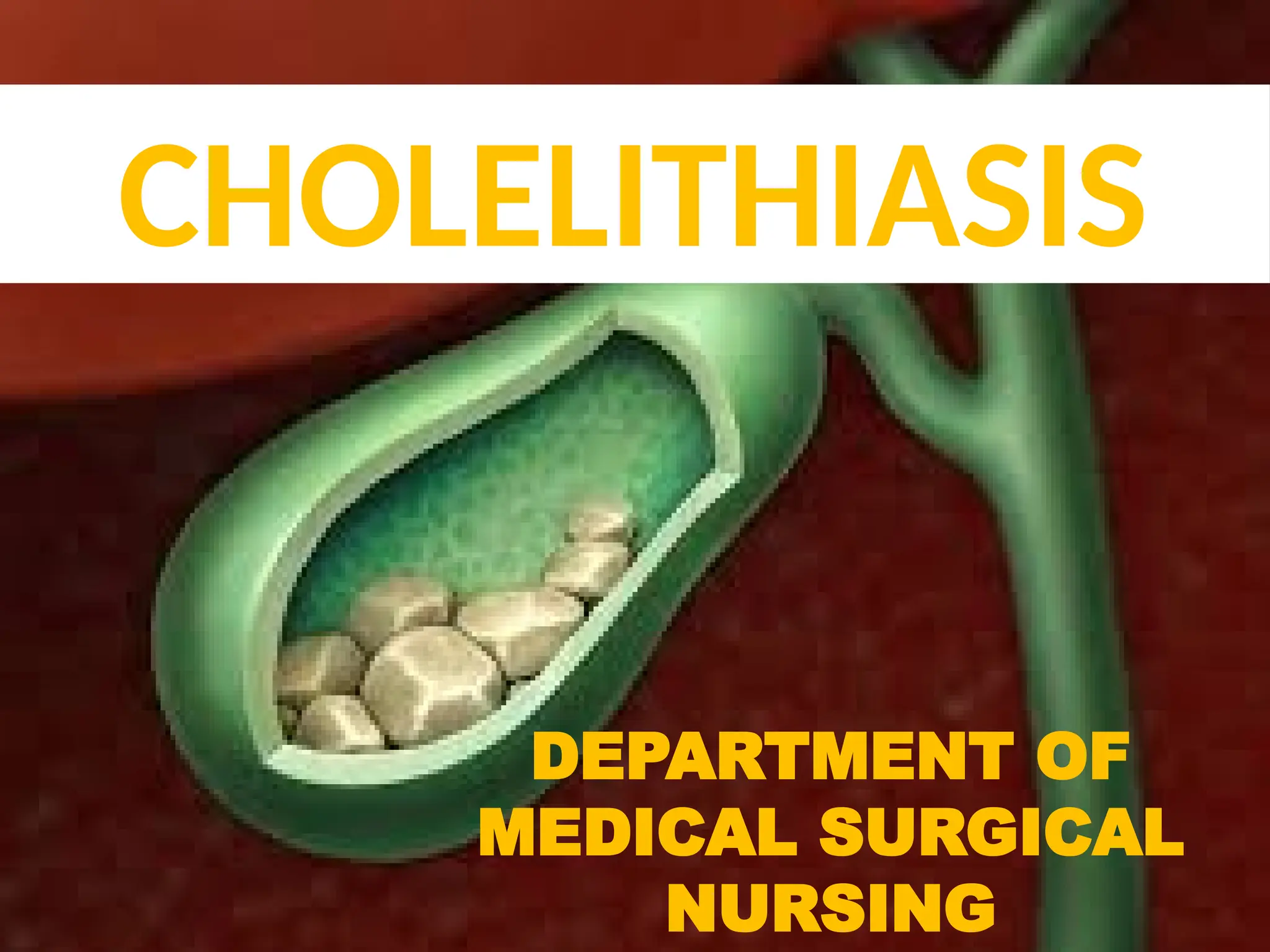 CHOLELITHIASIS (gall bladder stone).pptx